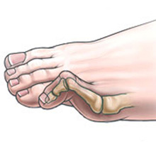Hammer Toe | Symptoms, causes and treatment| Sportsinjuryclinic.net