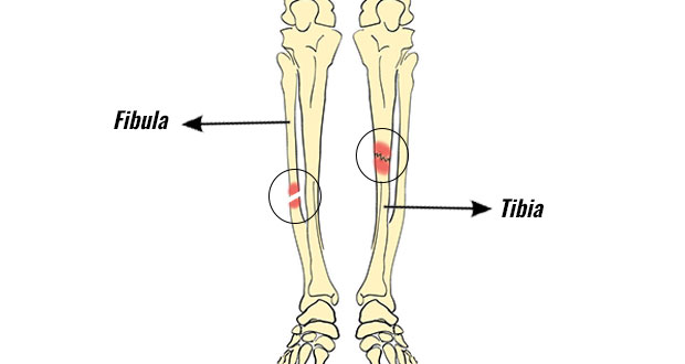 Broken Leg Explained - Leg Fractures & Stress Fractures
