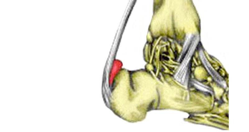 Achilles Bursitis | Retrocalcaneal Bursitis - Symptoms, Causes & Treatment