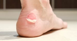 Bruised Heel - Symptoms, Causes, Treatment & Taping