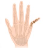 Hand & Finger Injuries - Sprains, Strains & Fractures Explained