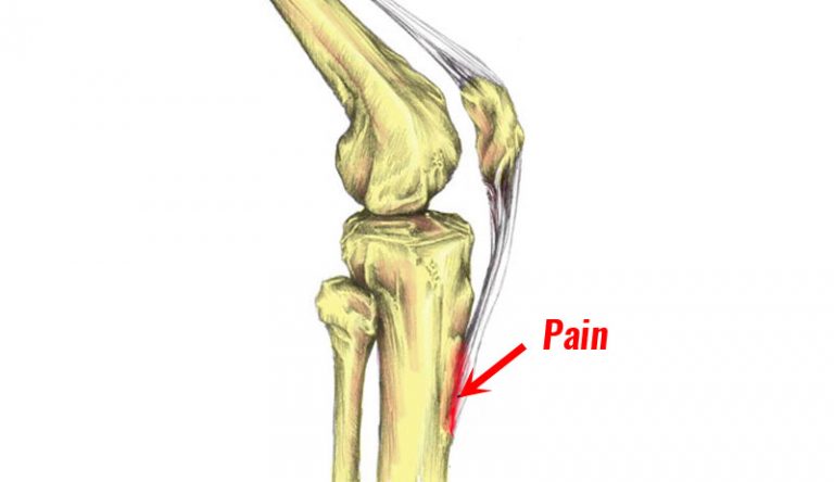 Knee Pain From Running - Top Five Causes & Treatment