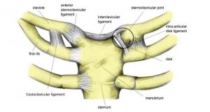 Sternoclavicular Sprain - Symptoms, Causes and Treatment