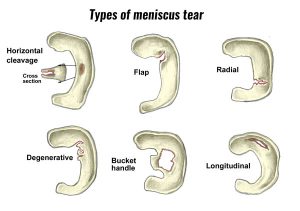 Torn Cartilage Meniscus - Symptoms, Causes, Treatment & Rehabilitation