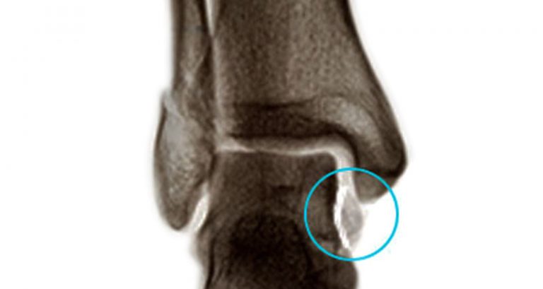 Ankle Avulsion Fracture Symptoms Causes And Treatment