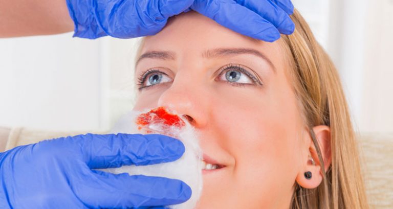 Nosebleed & Facial Injuries - Causes and Treatment
