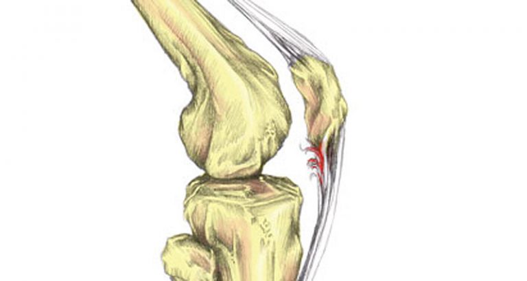 Hamstring Tendinopathy Rehabilitation Program - Sportsinjuryclinic.net