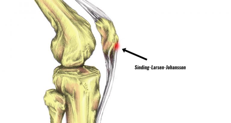 Sinding-Larsen-Johansson syndrome: Symptoms, Causes & Treatment