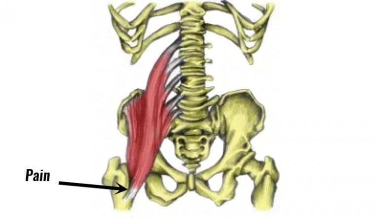 Hip Synovitis - Symptoms, Causes, Treatment & Rehabilitation
