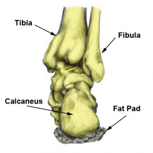 Calcaneal Fracture - Symptoms, Causes, Treatment and Rehabilitation