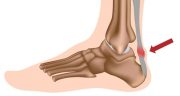 Foot drop - Causes & Treatment - Sportsinjuryclinic.net