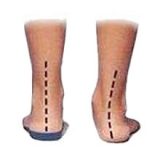 Overpronation (Foot Biomechanics) - Signs, Symptoms & Related Injuries