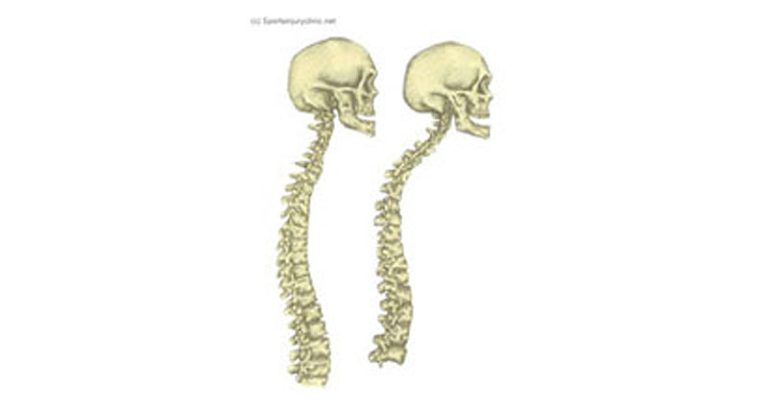 Scheuermann's Disease - Symptoms, Causes & Treatment