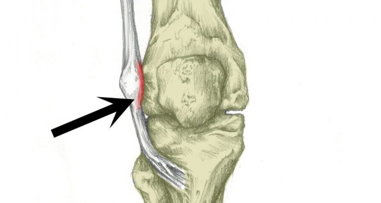 Iliotibial Band Syndrome Exercises - ITB Friction Syndrome Rehabilitation