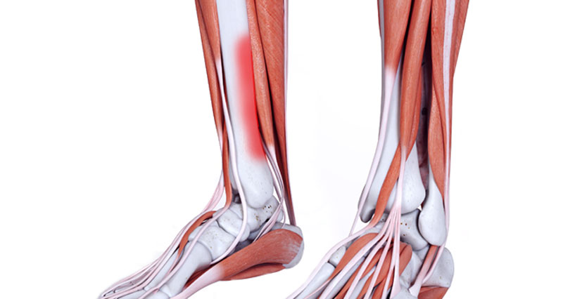 Shin Splints Symptoms Causes Treatment Taping Exercises
