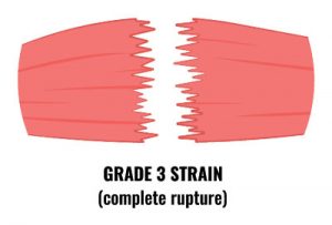 Calf Strain Diagnosis - Calf Strain Symptoms & Diagnosis