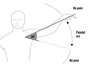 Shoulder Pain & Shoulder Injuries - Symptoms, Causes & Treatment