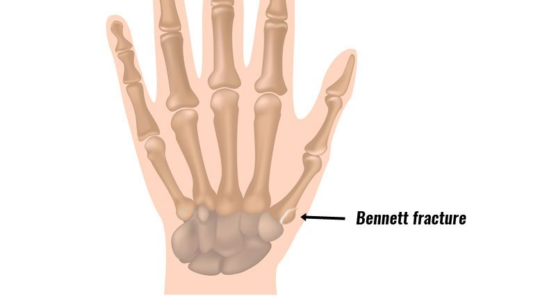 Bennett's fracture - Symptoms, Causes, Treatment and Rehabilitation