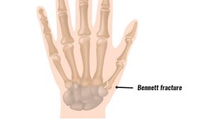 Triquetrum Fracture - Symptoms, Causes & Treatment.
