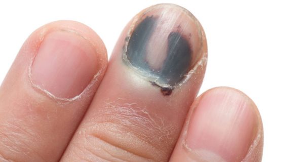 Black Fingernail - Symptoms, Causes & Treatment