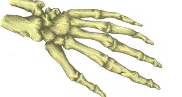 Hand & Finger Fractures - Types, Symptoms, Treatment & Exercises