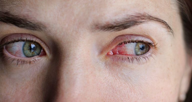 Conjunctivitis - Symptoms, Causes, Treatment & Prevention