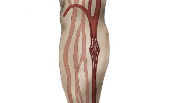 Calf Contusion - Symptoms, Causes, Treatment & Rehabiltiation