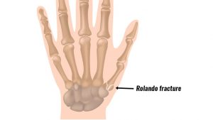 Triquetrum Fracture - Symptoms, Causes & Treatment.