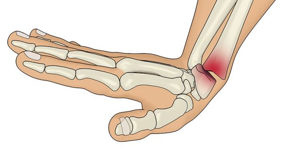 Smith's Fracture - Symptoms, Causes, Treatment & Surgery