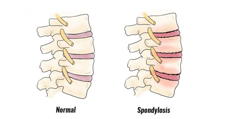 Spondylosis - Symptoms, Causes, Treatment and Rehabilitation