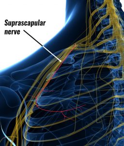 Suprascapular Neuropathy - Symptoms, Causes and Treatment