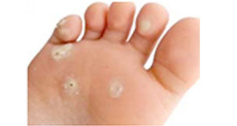 Verruca - Plantar Wart - Symptoms, Causes and Treatment