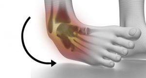 Peroneal Tendon Tear - Symptoms, Causes, Treatment, Exercises