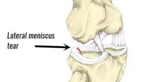 Lateral Knee Pain (Outside Of The Knee) - Symptoms, Treatment & Rehab