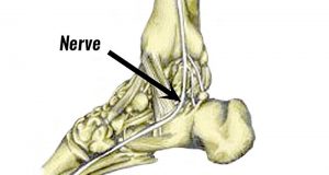 Inside Ankle Pain (Medial) - Symptoms, Causes &Treatment