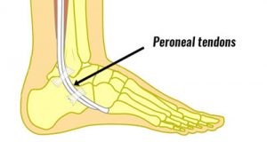 Outside Foot Pain - Symptoms, Causes, Treatment & Rehabilitation