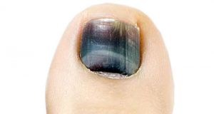 Toe Pain - Symptoms, Causes and Treatment