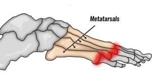 Forefoot Pain - Symptoms, Causes, Treatment and Rehabilitation