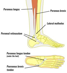 Peroneal Tendonitis (Tendinopathy) - Symptoms, Causes & Treatment