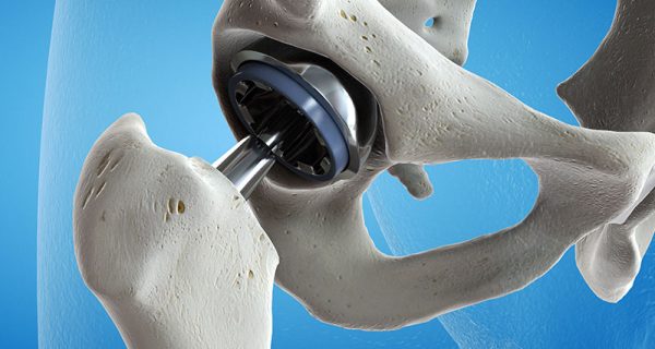 Hip replacement Vs Resurfacing - Sportsinjuryclinic.net