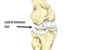 McMurray's Test - Sportsinjuryclinic.net