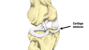 Thessaly Test For Meniscus Tears - Sportsinjuryclinic.net